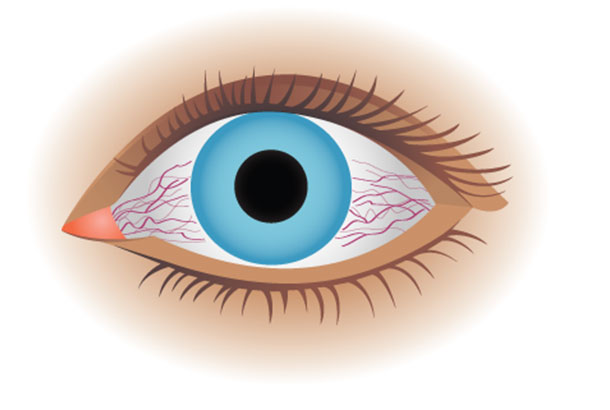 Clinical Contact Lens Management Guide
