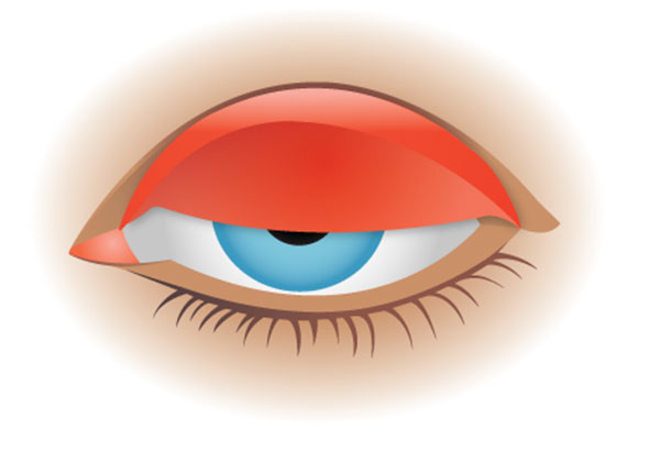 Clinical Contact Lens Management Guide