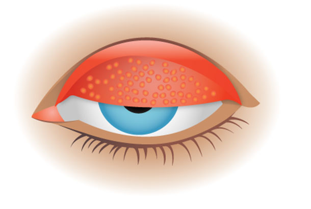 Clinical Contact Lens Management Guide