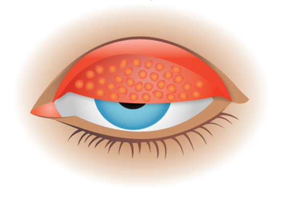 Clinical Contact Lens Management Guide