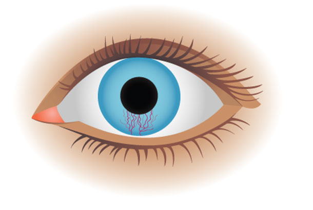 Clinical Contact Lens Management Guide